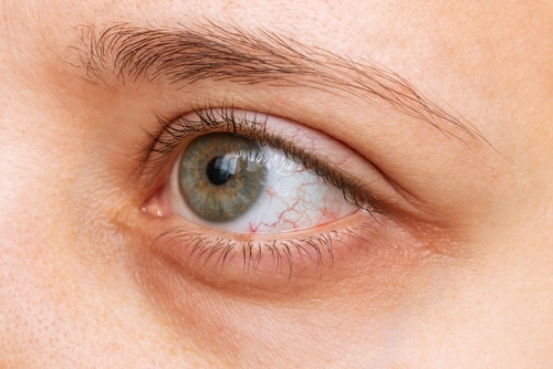 Is There a Time of Year When Dry Eye Is Worse? | Blaine Eye Clinic