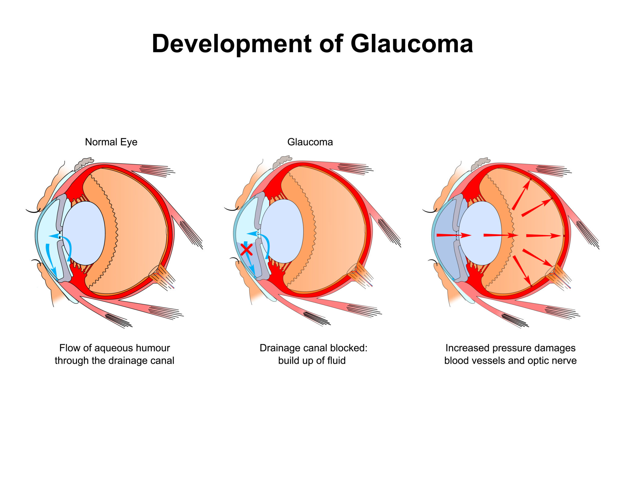 Can You Do Anything To Prevent Glaucoma From Getting Worse? | Blaine ...